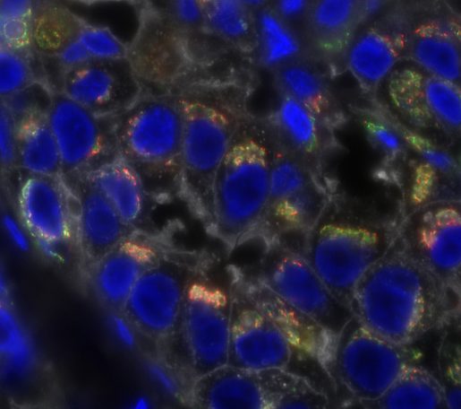How neutrophils help triple-negative breast cancer cells spread | BCM
